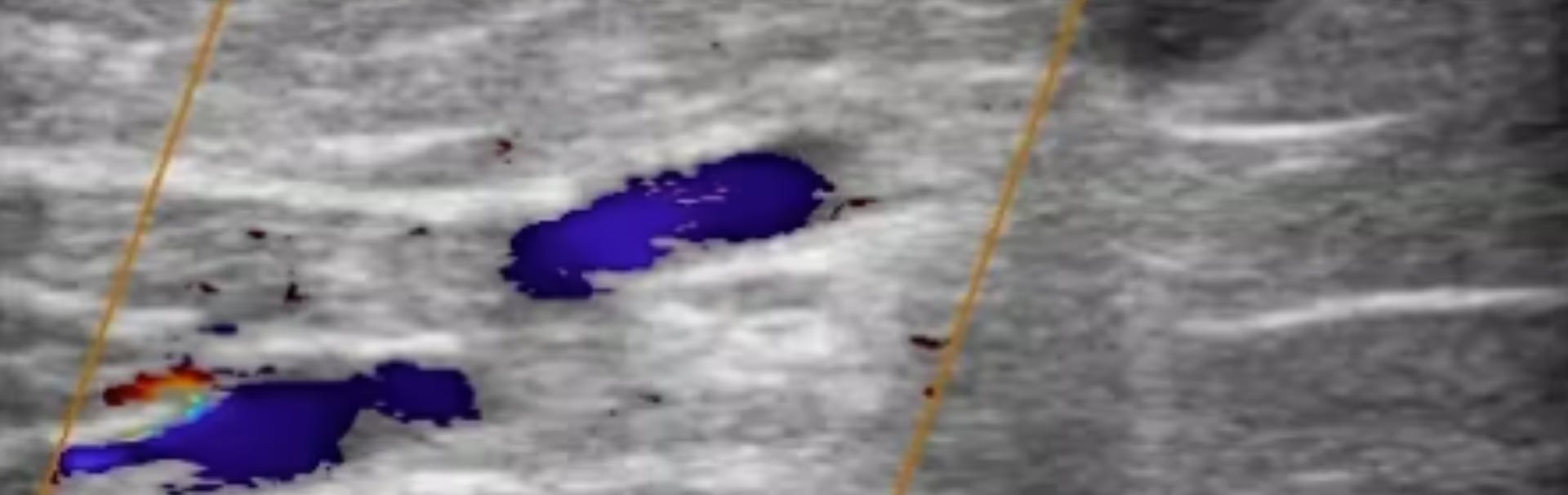 Doppler Venoso De Miembros Inferiores Coaching Courseticket